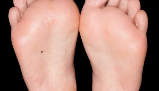 What do Moles on different Parts of Your Body Tell about You and Your ...